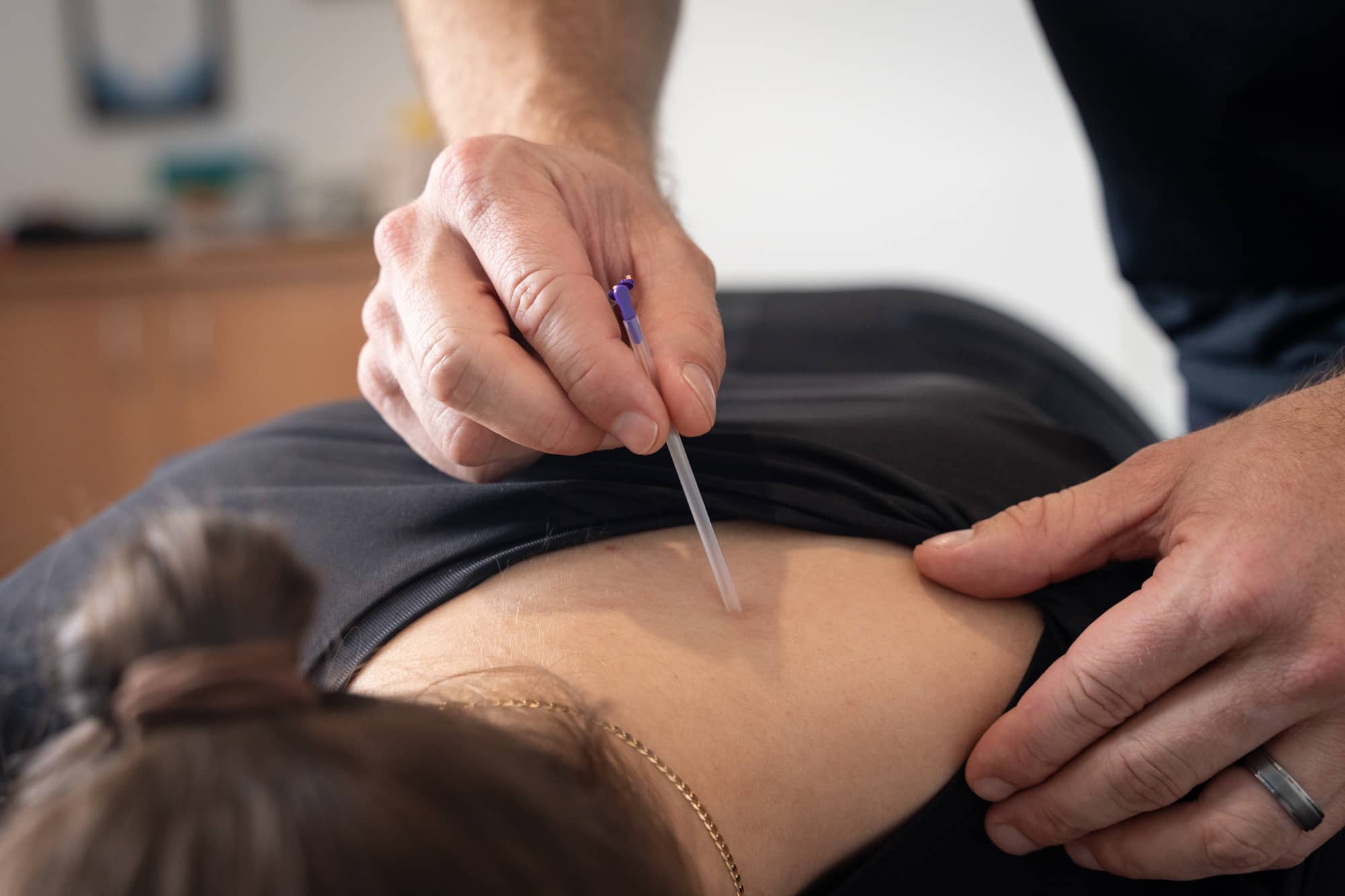 Dry Needling Shelley | Targeted Muscle Pain Relief